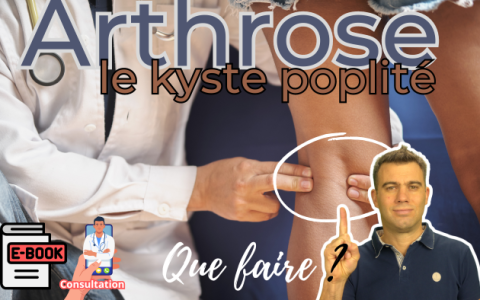 Arthrose et kyste poplité, que faire